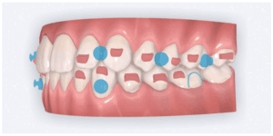 Angel Aligner — transforming approaches to complex cases