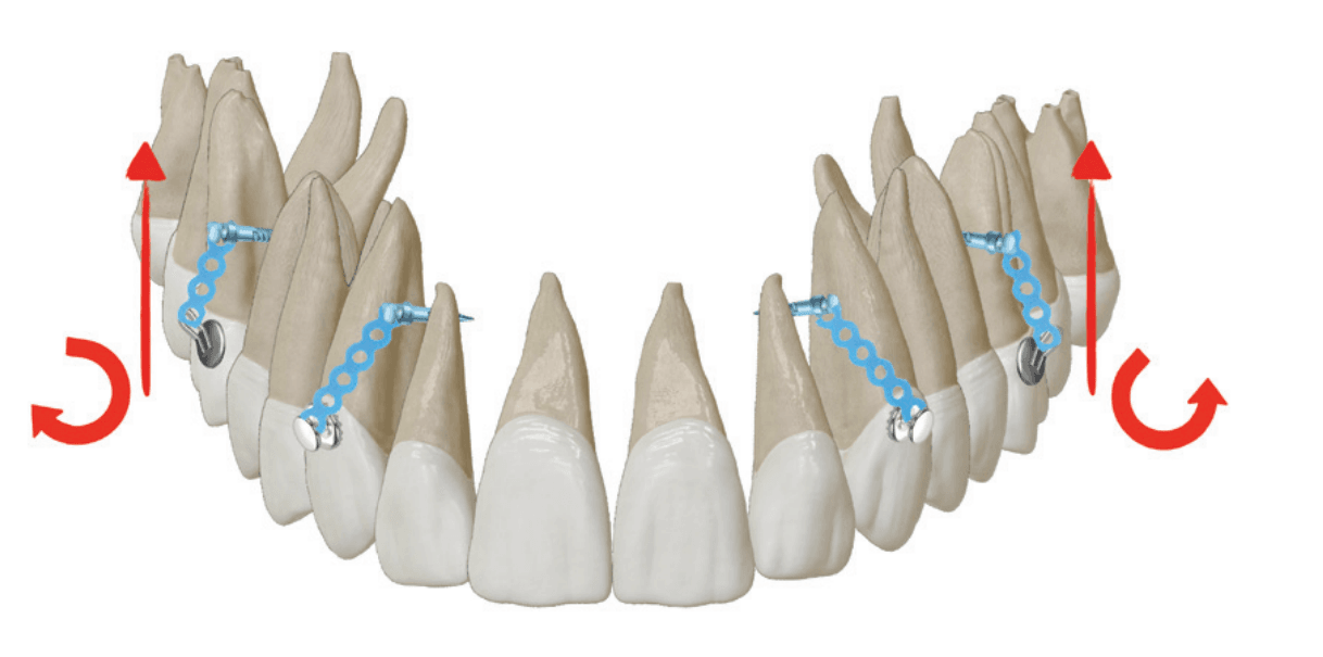 Angel Aligner — transforming approaches to complex cases