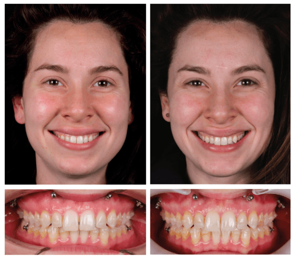 Angel Aligner — transforming approaches to complex cases