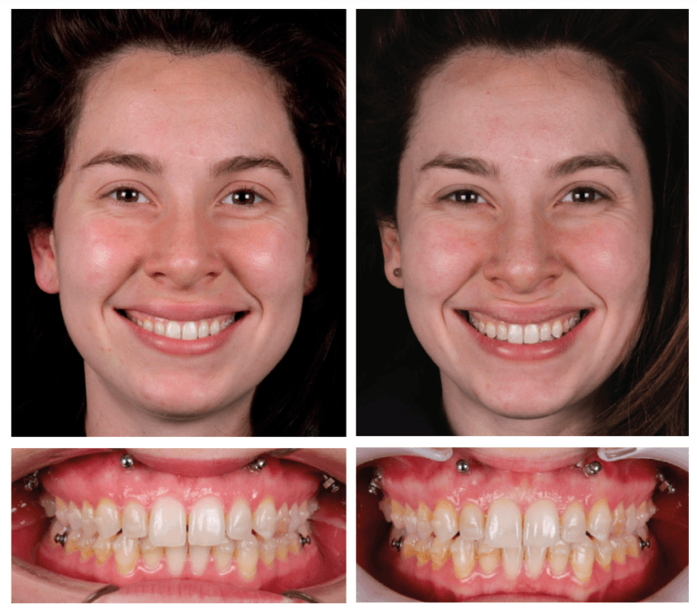 Angel Aligner — transforming approaches to complex cases