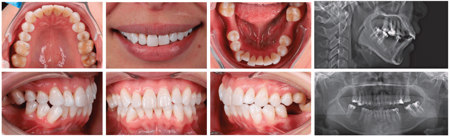 Angel Aligner — transforming approaches to complex cases