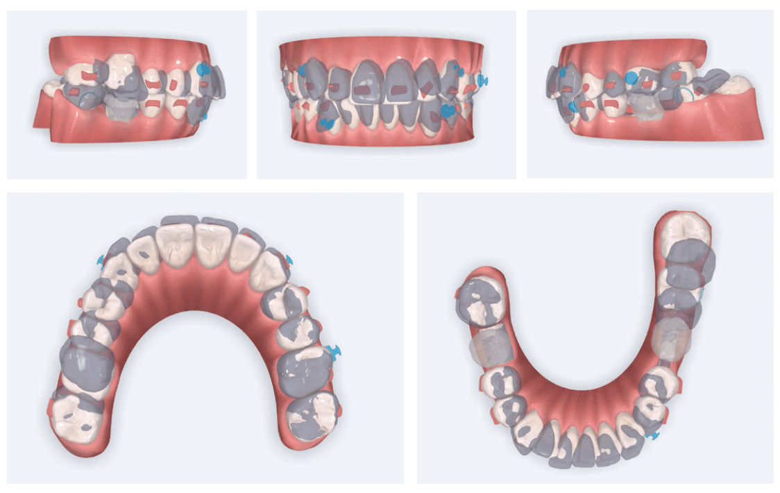 Angel Aligner — transforming approaches to complex cases