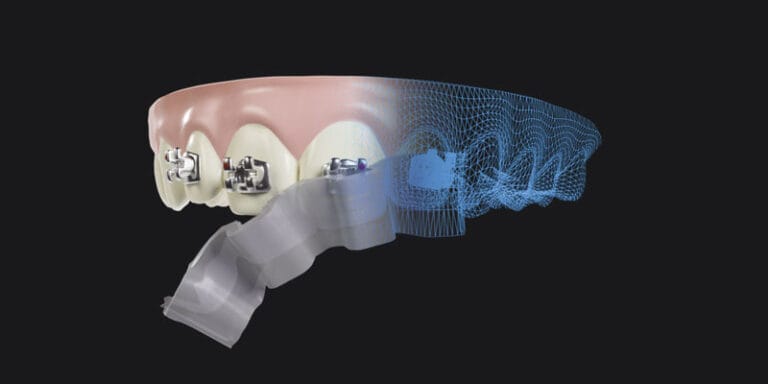 DIBS AI — digital bonding significantly reduces treatment time